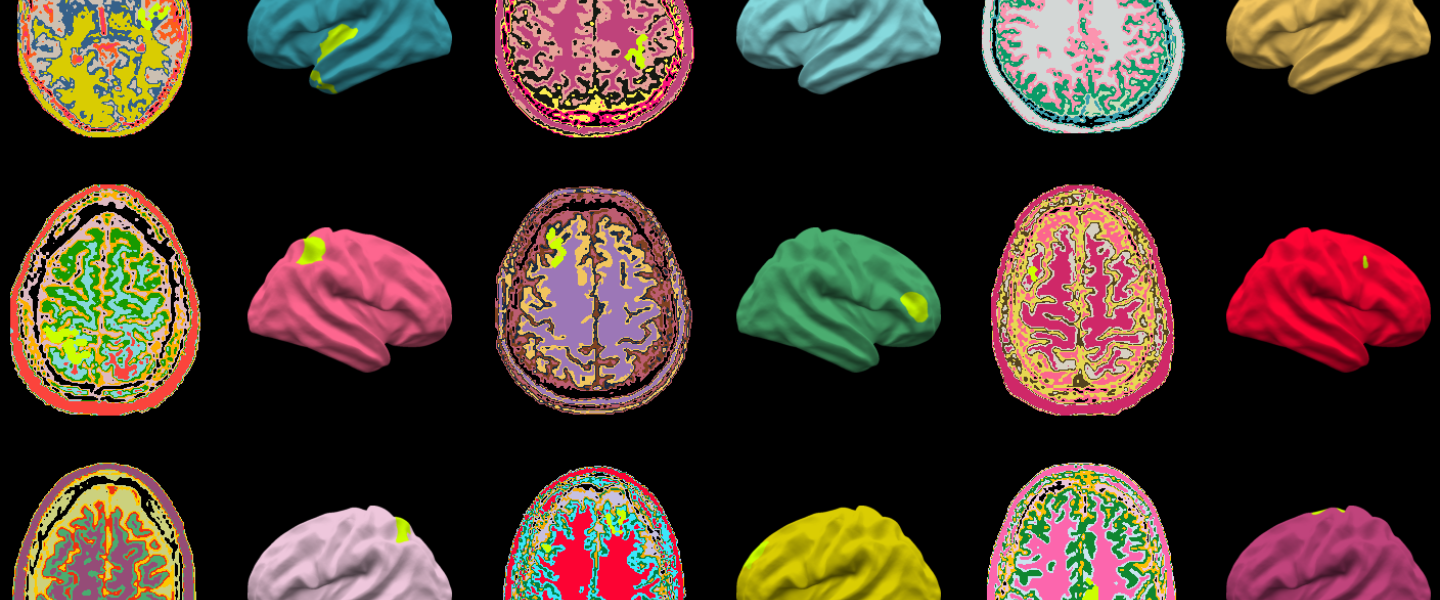AI algorithm detects brain abnormalities to help cure epilepsy - The ...