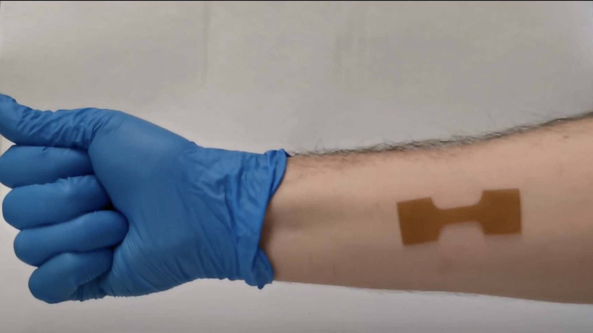 3D printed wound dressing improves treatment for burns and cancer ...