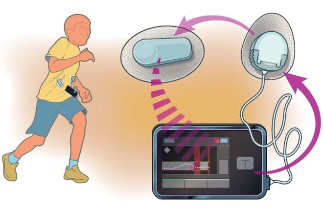 Artificial pancreas revolutionizes blood sugar control for kids with ...