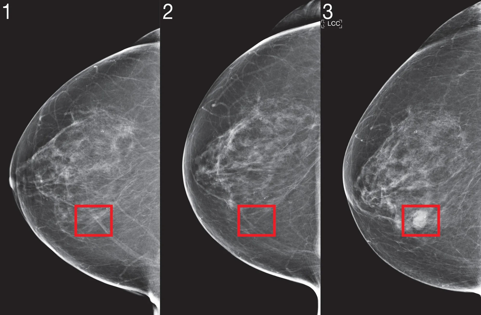 Deep-learning AI system revolutionizes breast cancer treatment - The ...