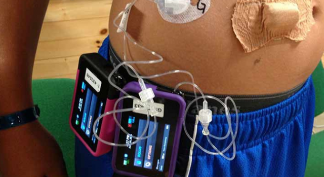 Do-It-Yourself artificial pancreas given approval by team of experts ...