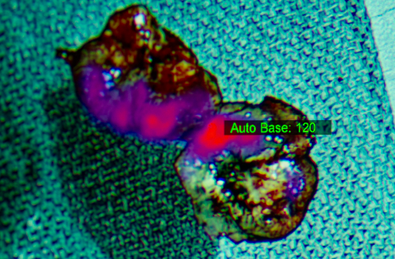 'Glowing Tumor' imaging drug will revolutionize lung cancer surgery ...