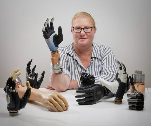 First-ever bionic hand actually merges with user’s nervous and skeletal ...