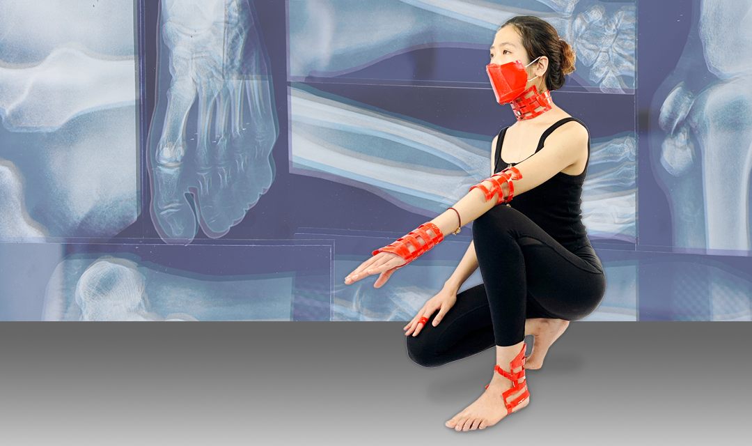New light-weight and comfortable casts self-adjust during the healing ...