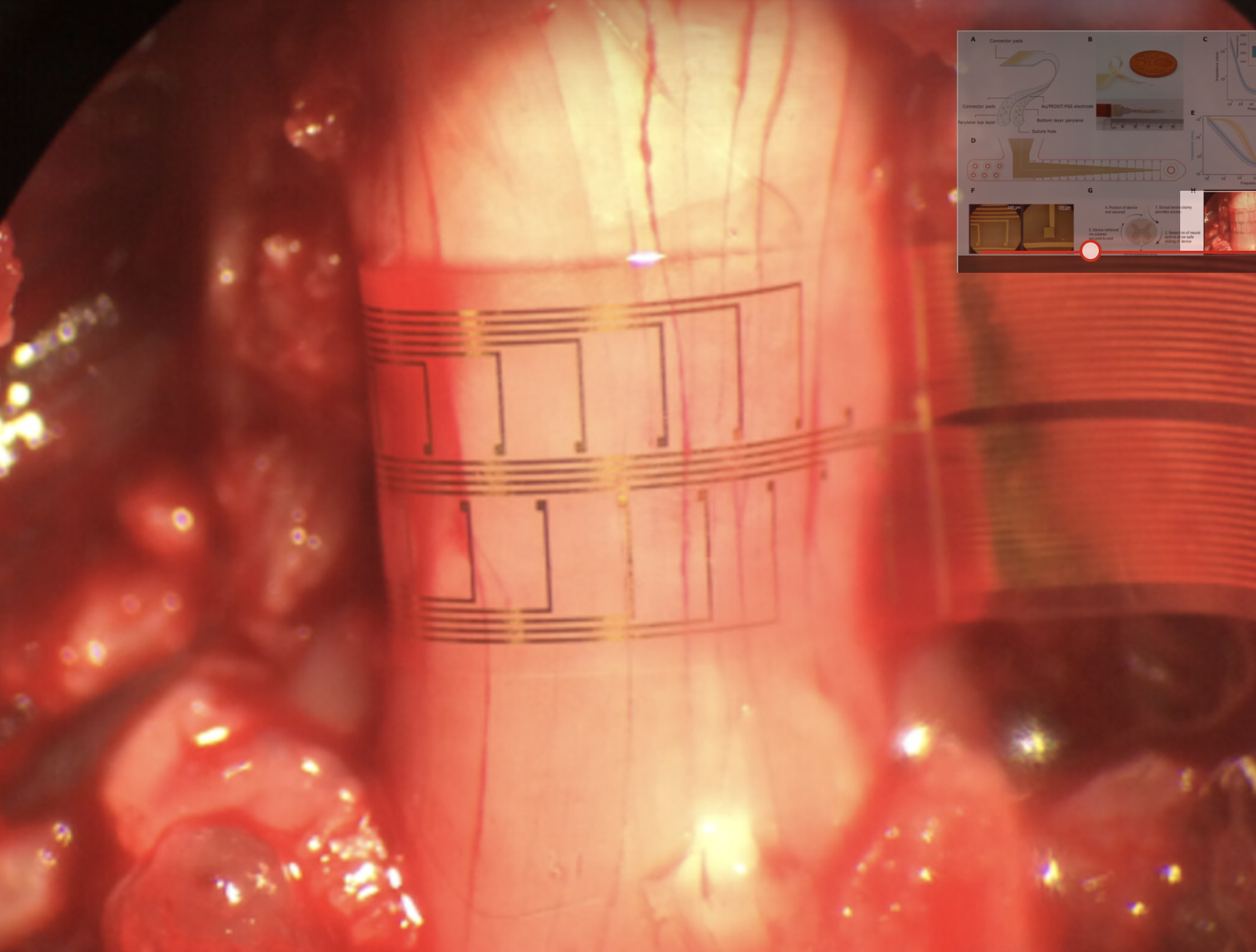 Flexible electronic device wraps around the spinal cord ...