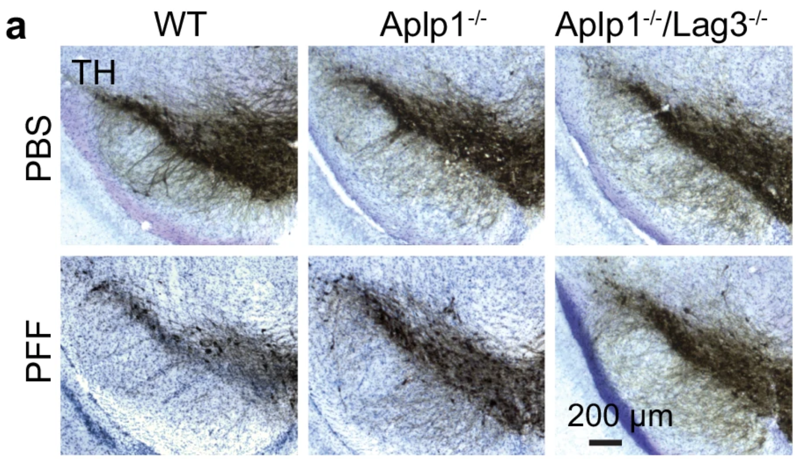 Cancer drug could help prevent Parkinson’s disease, study finds - The ...