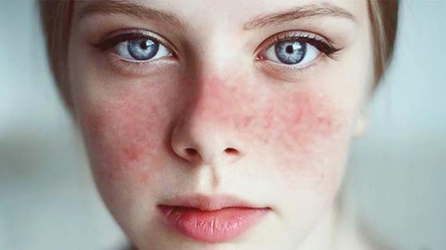 Scientists have finally discovered the cause of lupus - The Brighter ...
