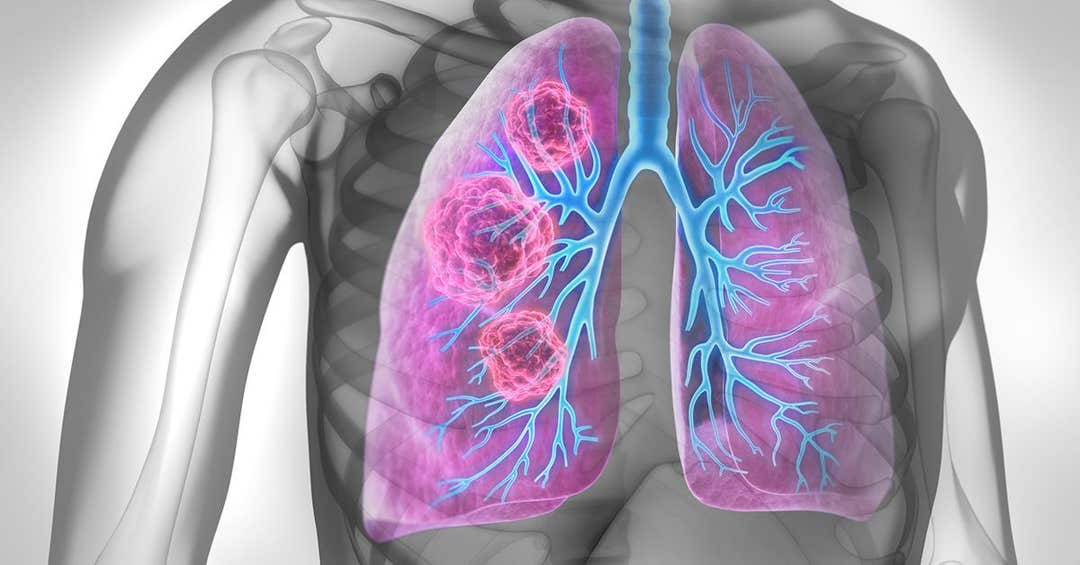 Scientists discover why lungs are so prone to developing cancer - The ...