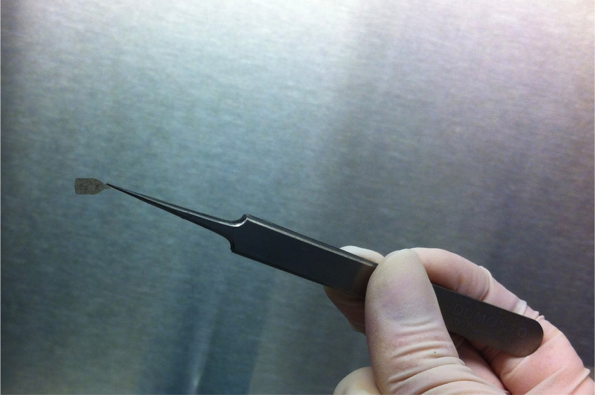 Tiny eye implant could restore vision lost to macular degeneration ...